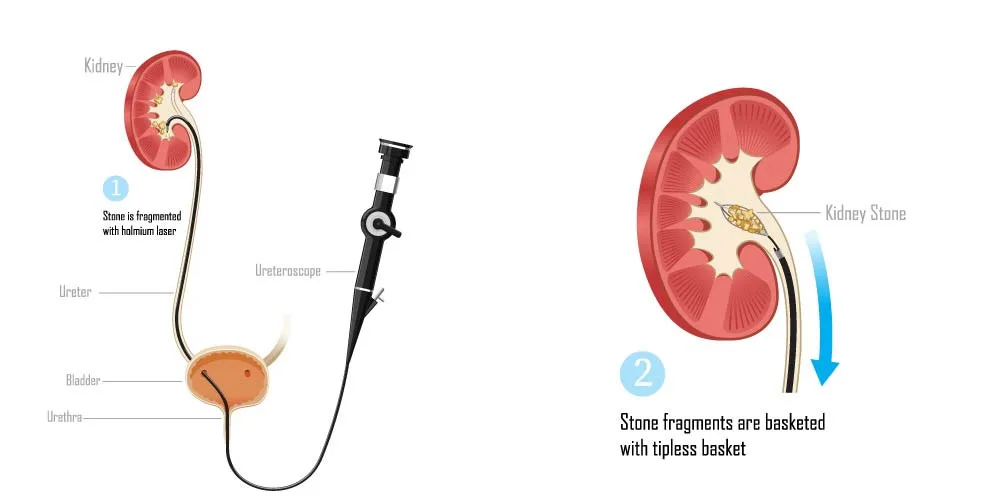 RIRS (Laser Treatment for kidney stone) | Dr. Prakash Sankapal
