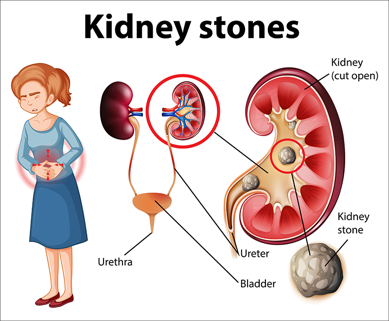 Exploring the Advantages of RIRS Surgery for Kidney Stones - Dr. Prakash Sankapal